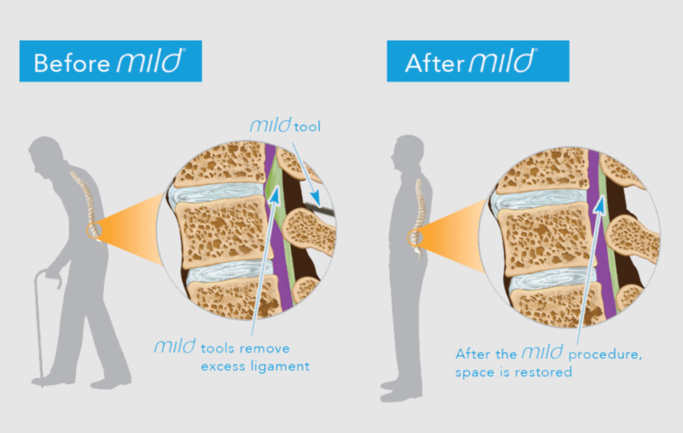 Minimally Invasive Lumbar Decompression | Nexus Pain Center